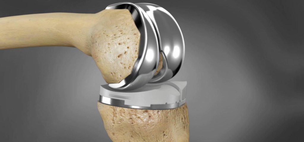 Prótesis de Cadera y Rodilla – Dra. Yuri Beltrán